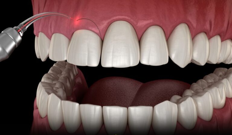 Gingival Diseases Magi Clinic